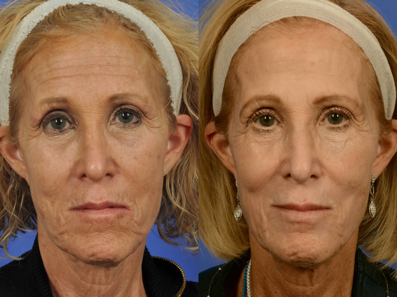 Hetter Peel Before & After Photos | W Cosmetic Surgery