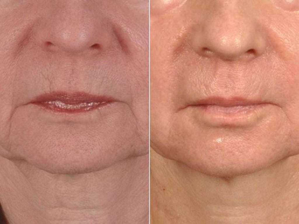 Microneedling Before & After Photos | W Cosmetic Surgery