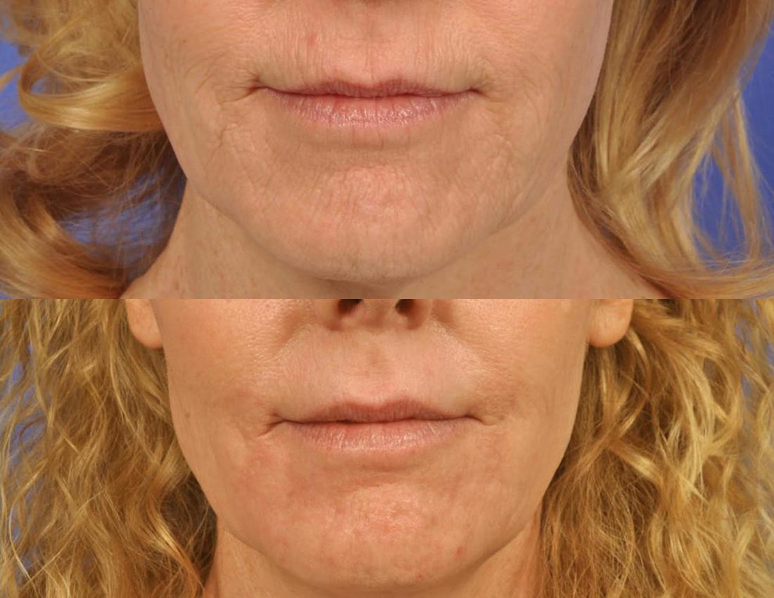 Microneedling Before & After Photos | W Cosmetic Surgery