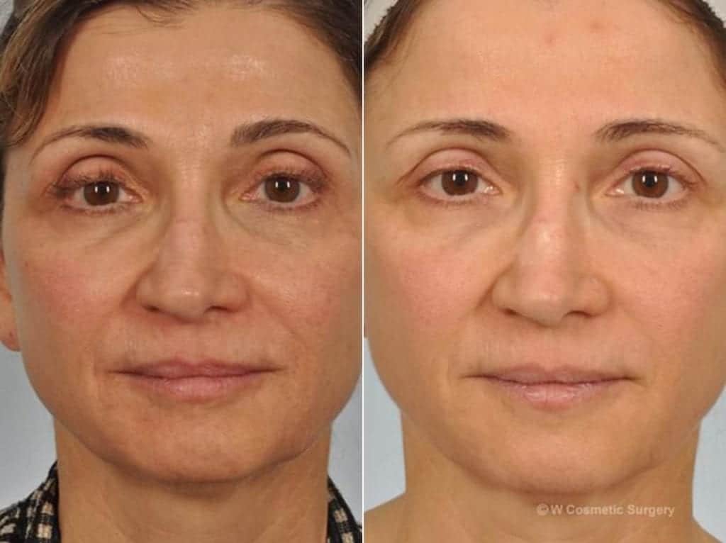 Microneedling Before & After Photos | W Cosmetic Surgery