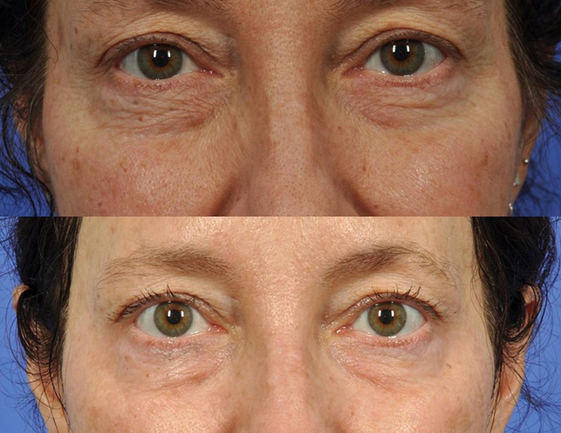 Microneedling Before & After Photos | W Cosmetic Surgery