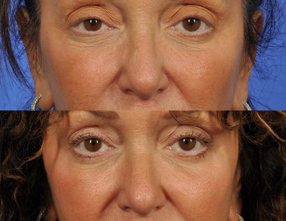 Microneedling Before & After Photos | W Cosmetic Surgery