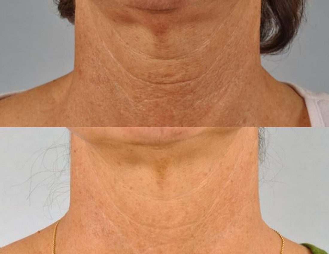 Neck Firming Before & After Photos | W Cosmetic Surgery