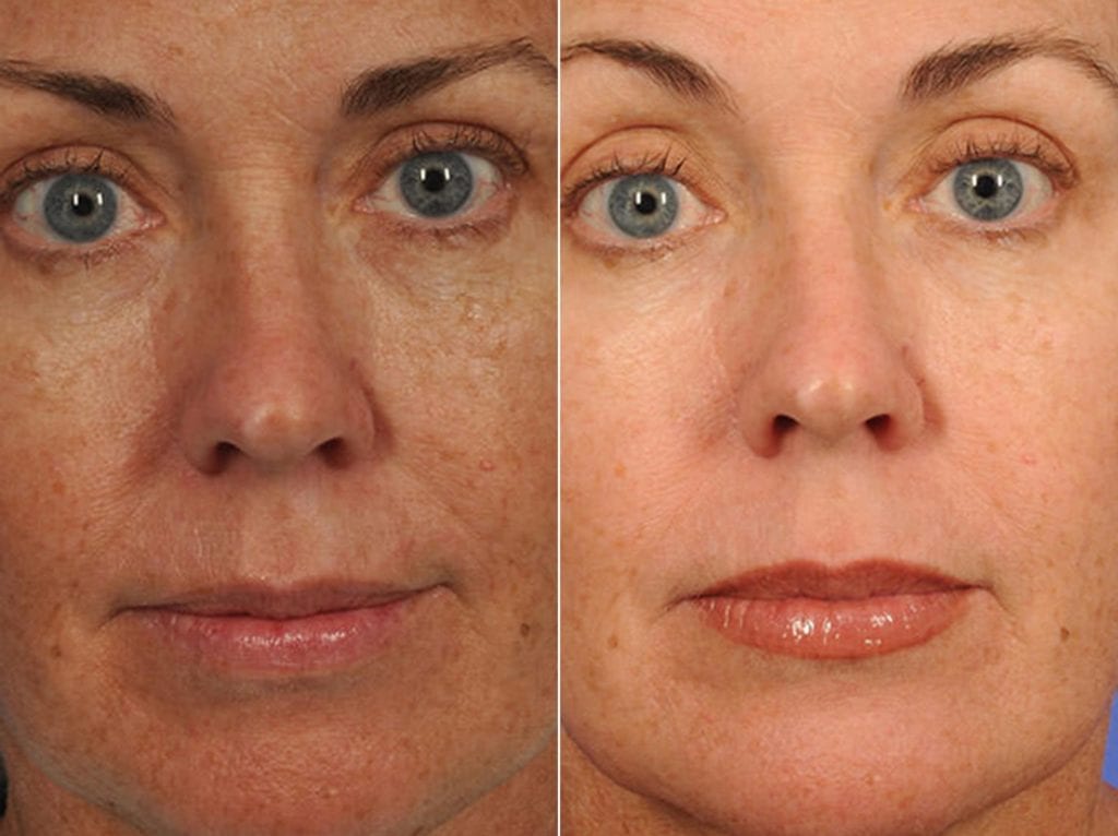 Peels and Microdermabrasion Before & After Photos | W Cosmetic Surgery