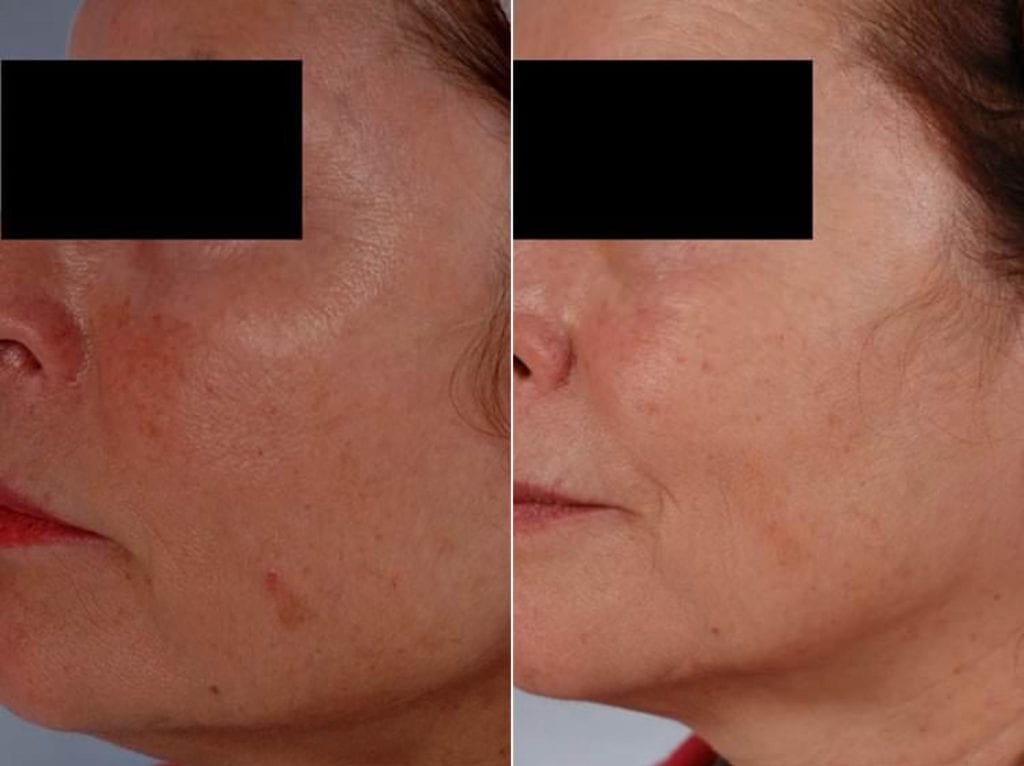 Peels and Microdermabrasion Before & After Photos | W Cosmetic Surgery
