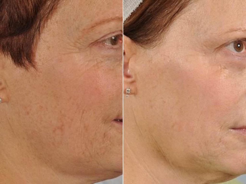 Peels and Microdermabrasion Before & After Photos | W Cosmetic Surgery