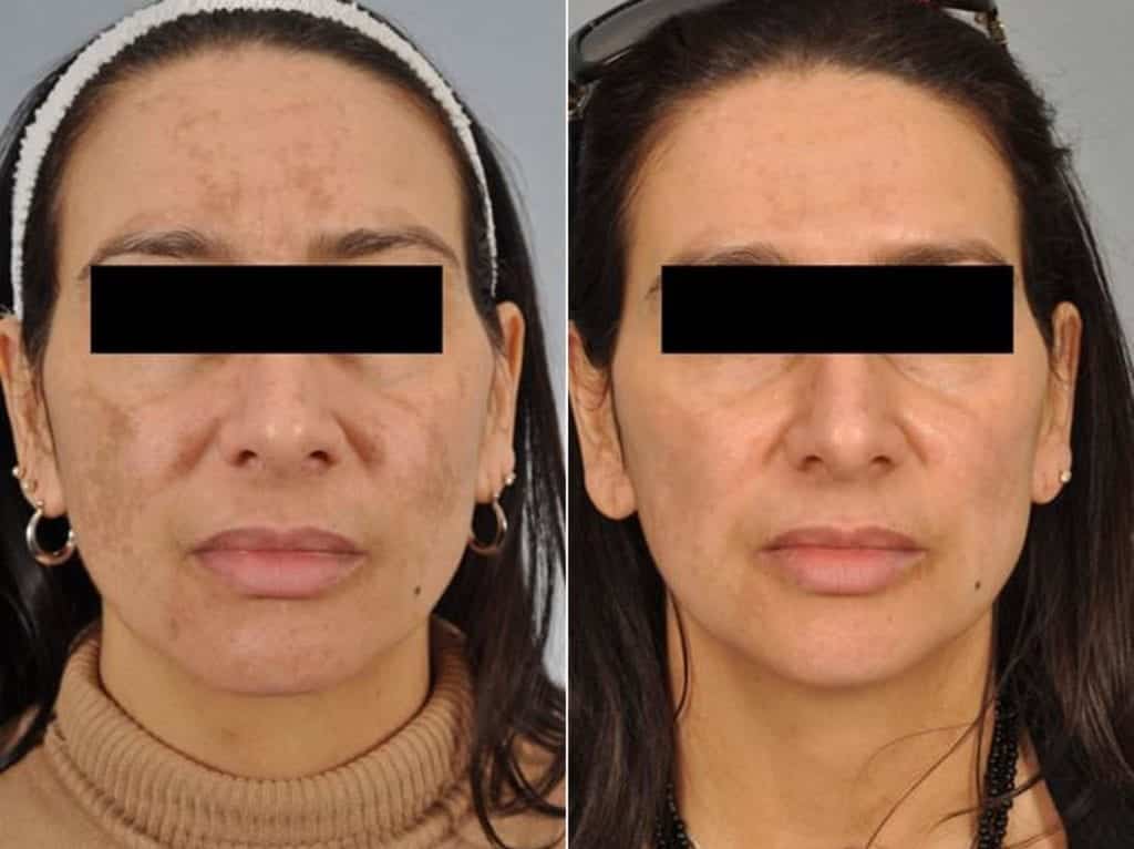 Peels and Microdermabrasion Before & After Photos | W Cosmetic Surgery