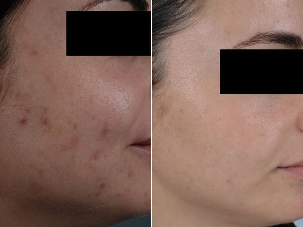 Peels and Microdermabrasion Before & After Photos | W Cosmetic Surgery