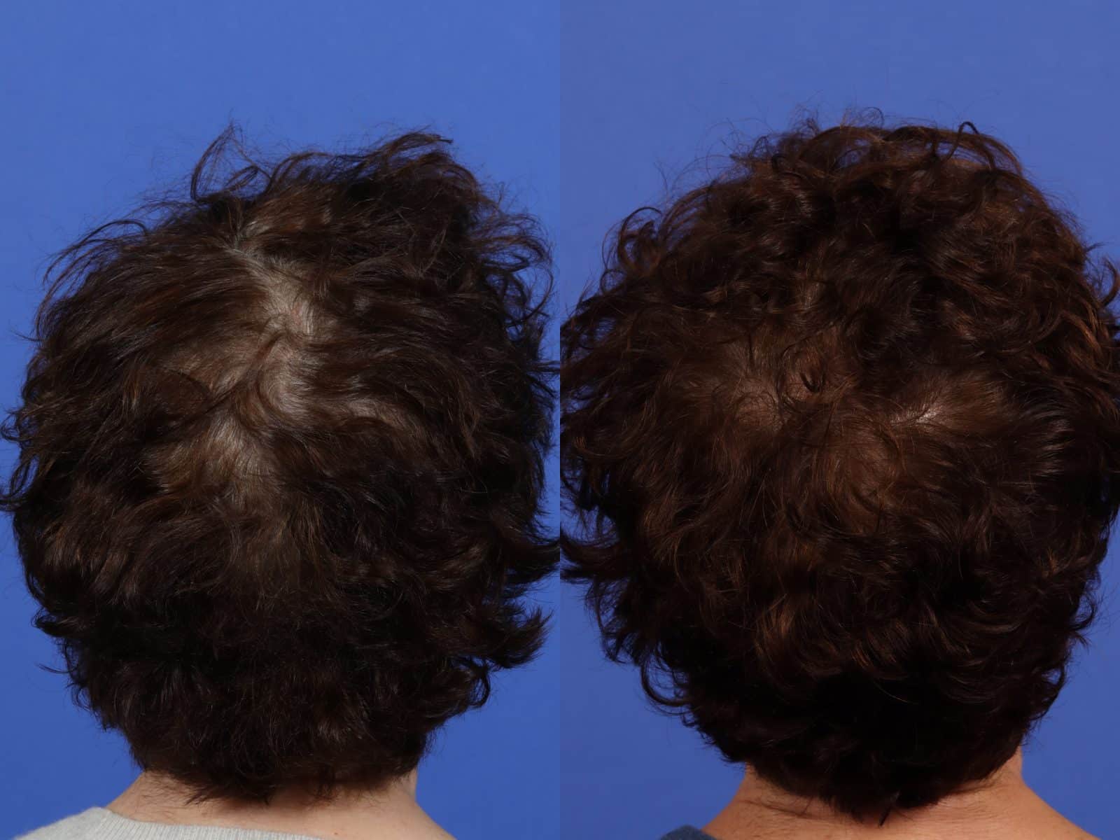 PRP for Hair Loss Before & After Photos | W Cosmetic Surgery