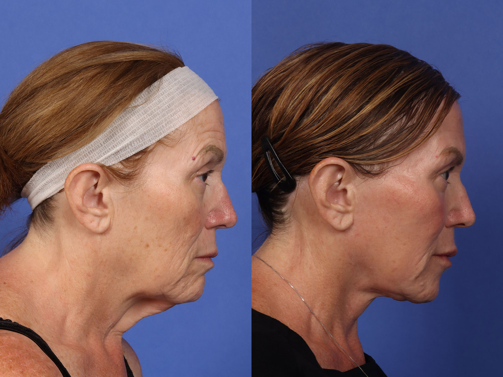 Neck Lift Before & After Photos | W Cosmetic Surgery