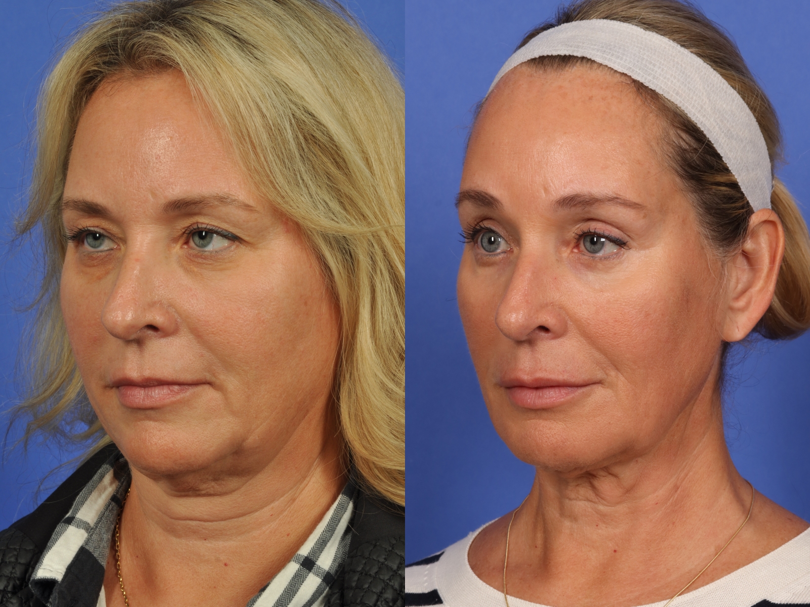 Mid Facelift Before & After Photos | W Cosmetic Surgery