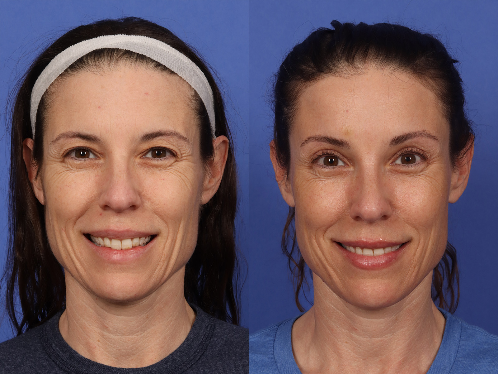 Brow Lift Before & After Photos | W Cosmetic Surgery