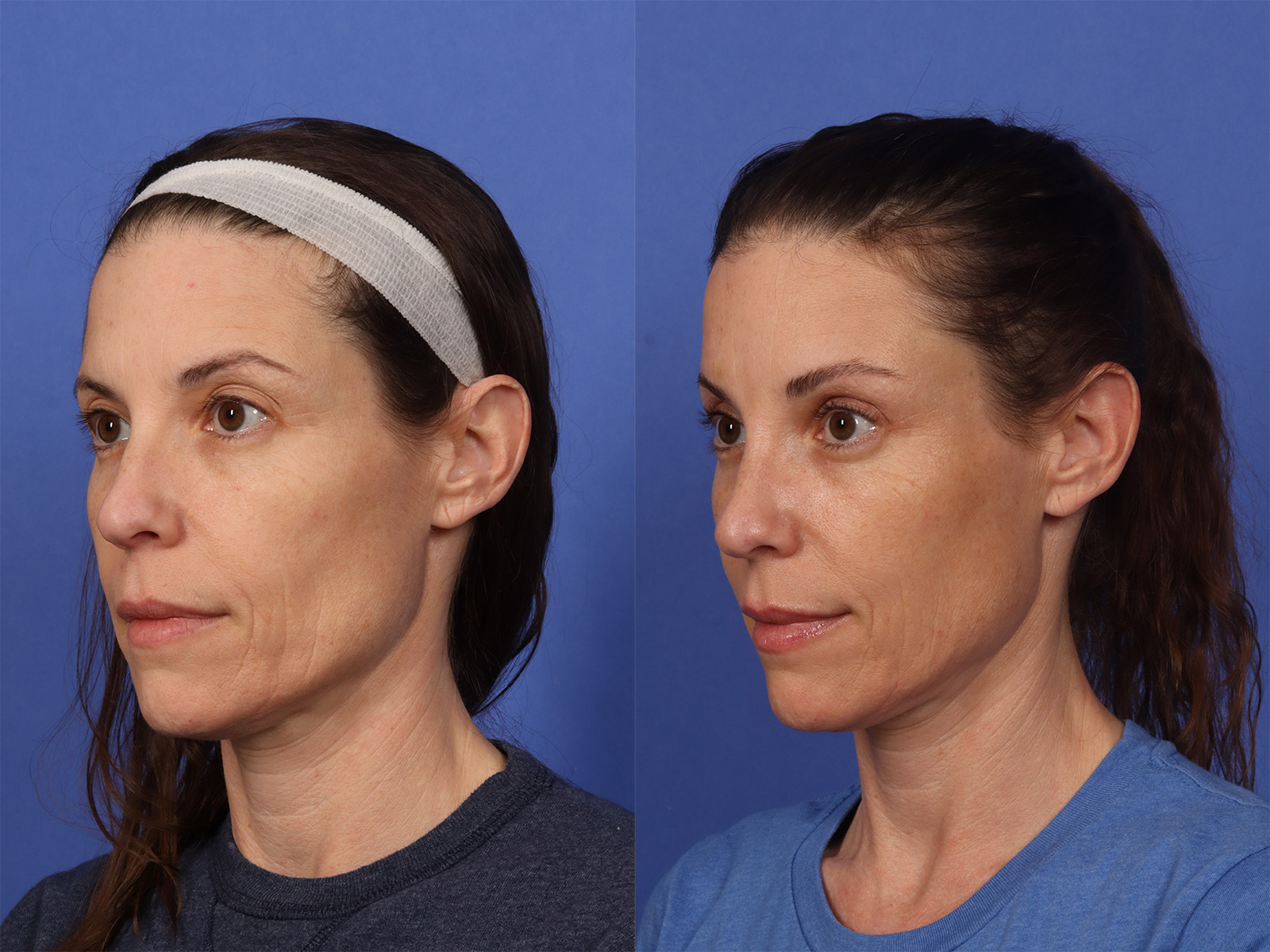 Brow Lift Before & After Photos | W Cosmetic Surgery