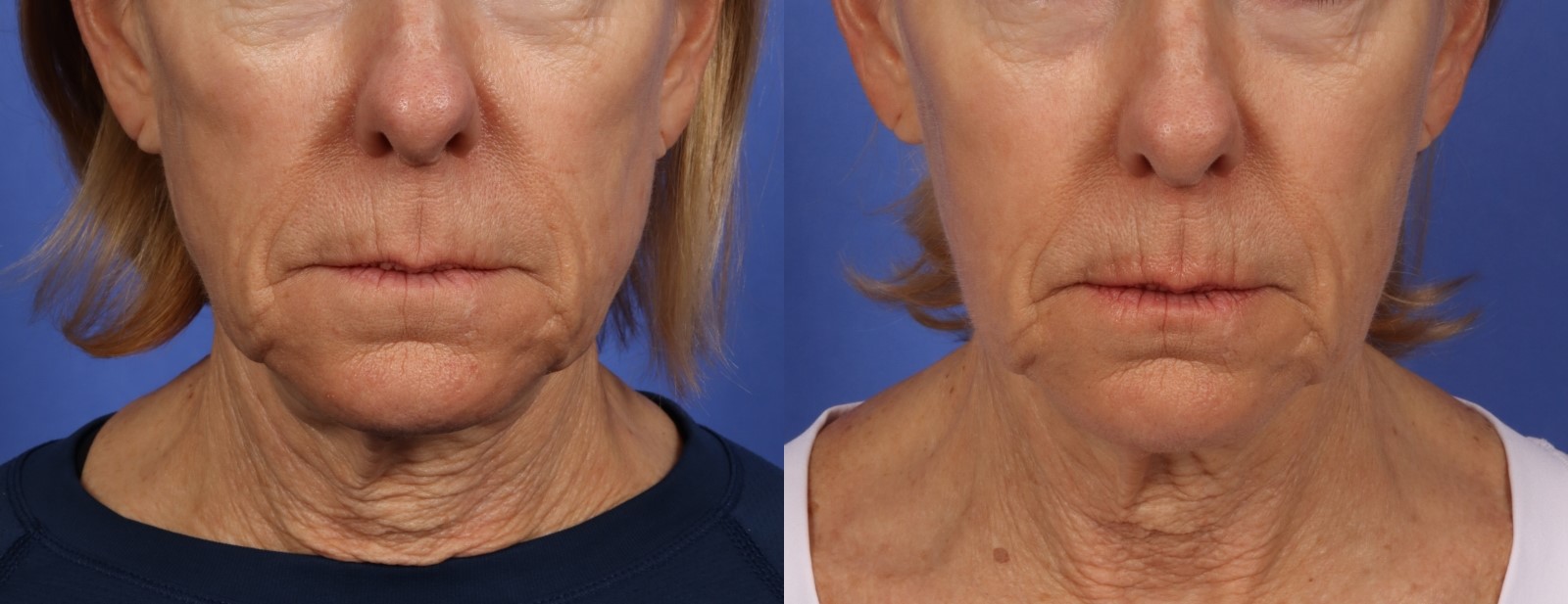 Sculptra Before & After Photos | W Cosmetic Surgery