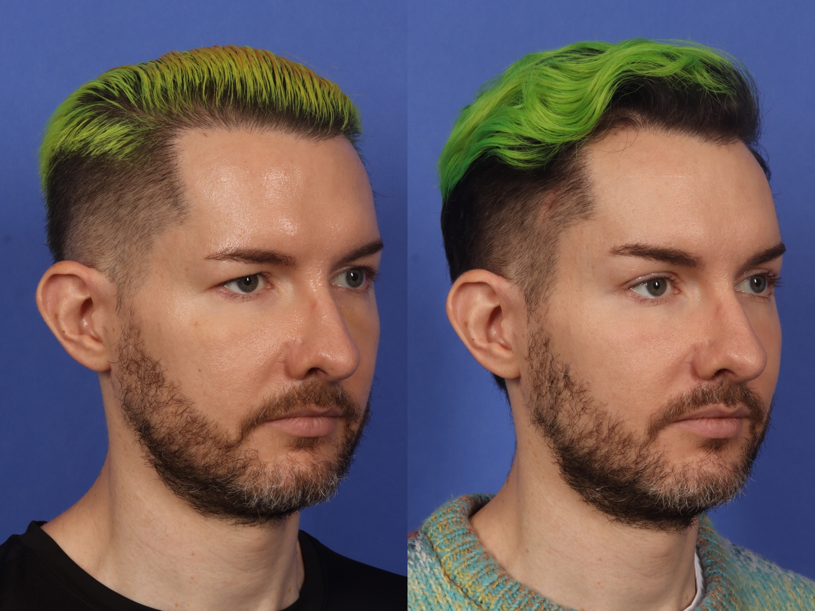 Patient 289125 | Brow Lift Before & After Photos | W Cosmetic Surgery