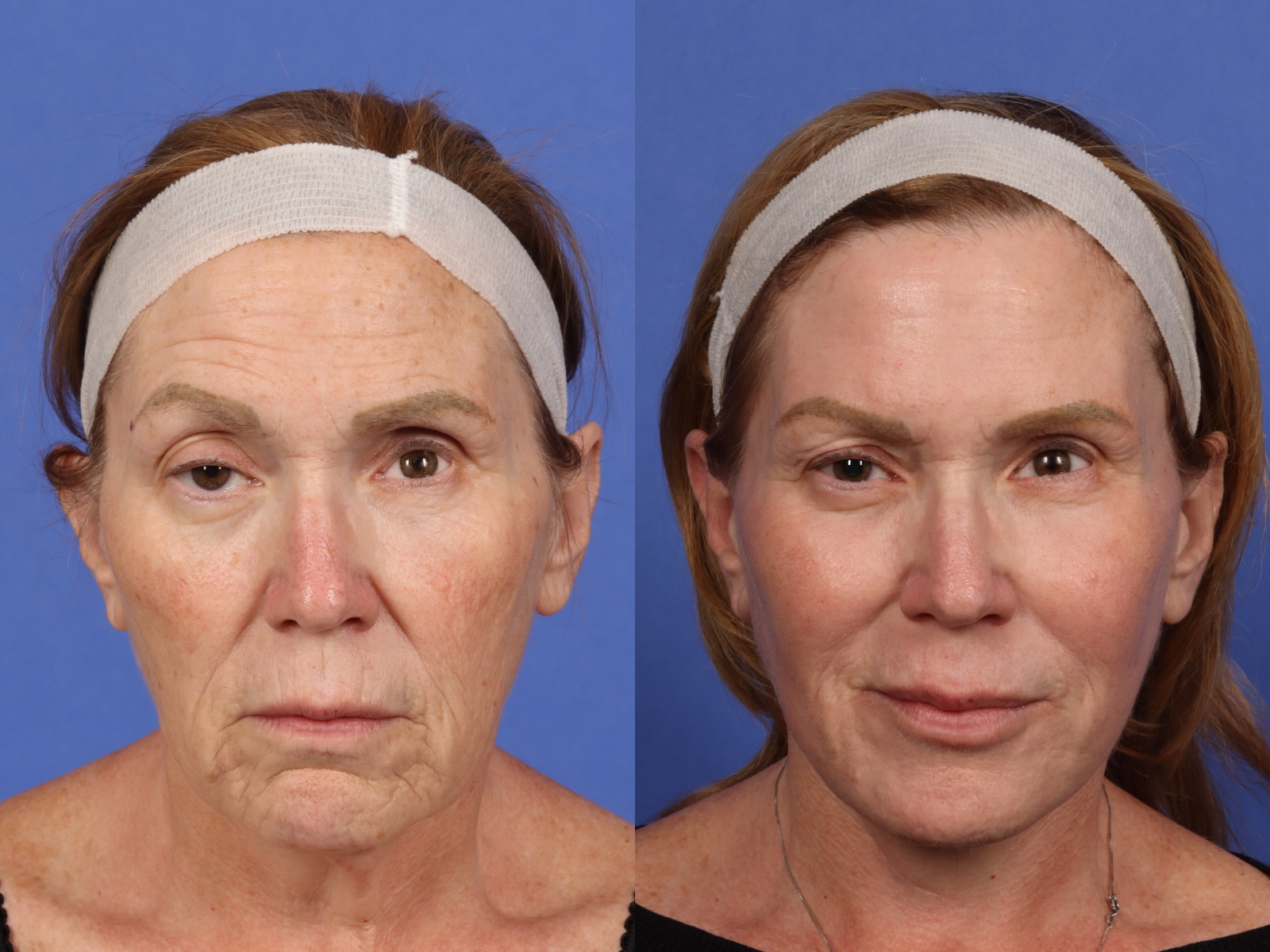 UltraClear™ Laser Before & After Photos | W Cosmetic Surgery