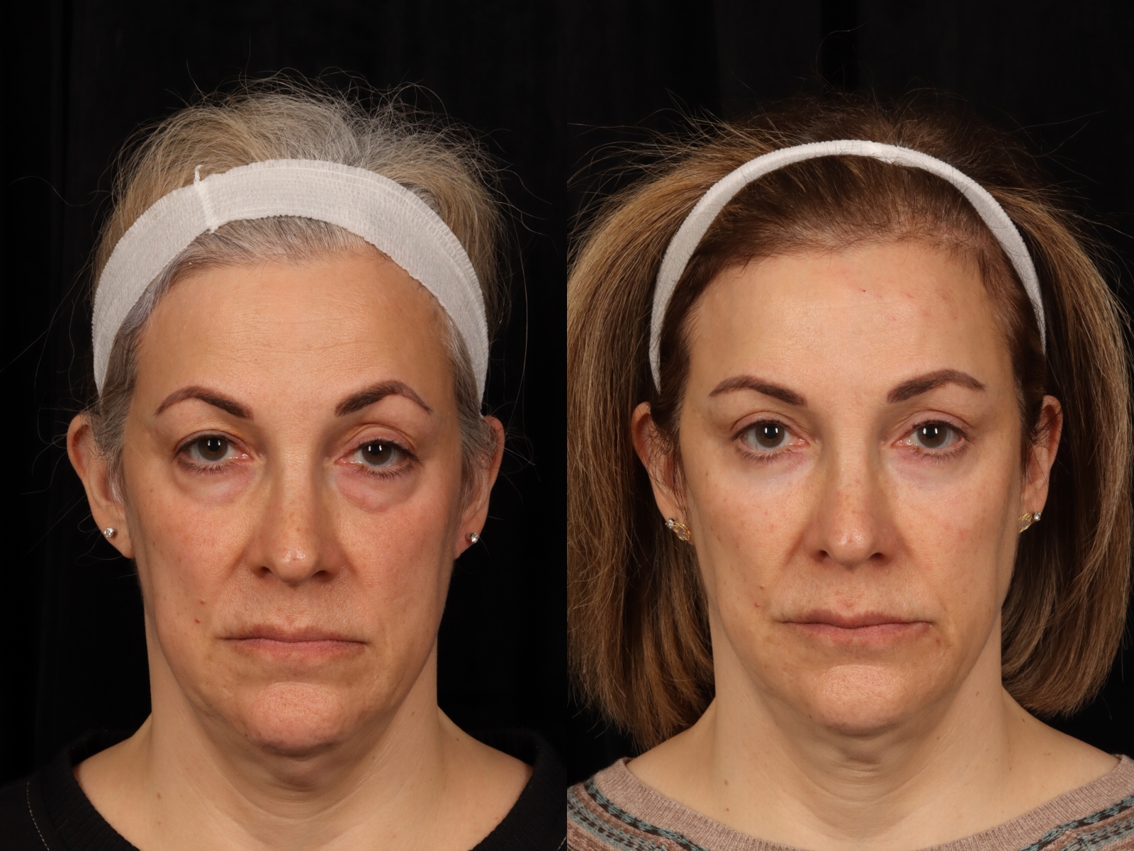 Mid Facelift Before & After Photos | W Cosmetic Surgery