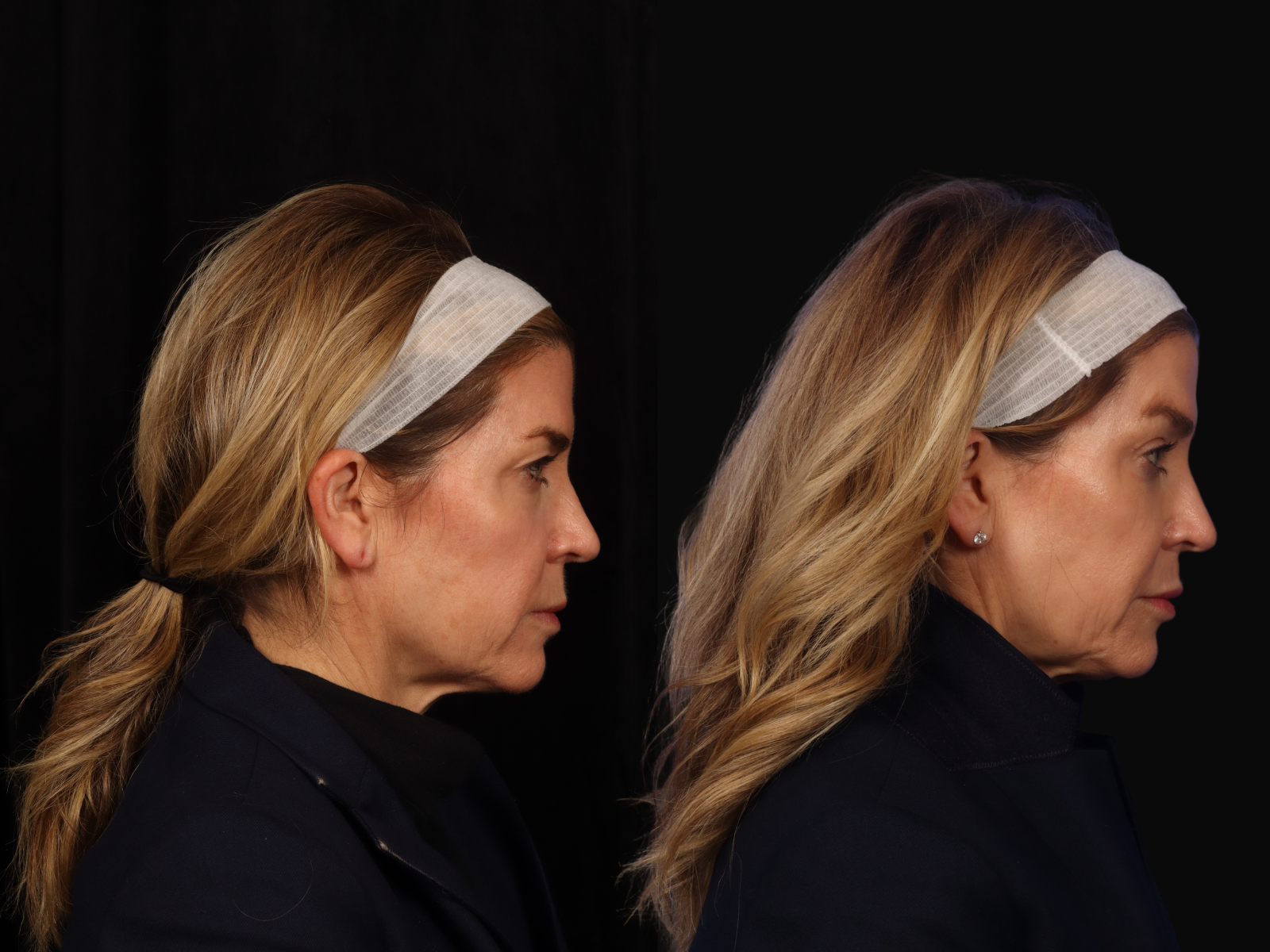 Laser Skin Resurfacing Before & After Photos | W Cosmetic Surgery