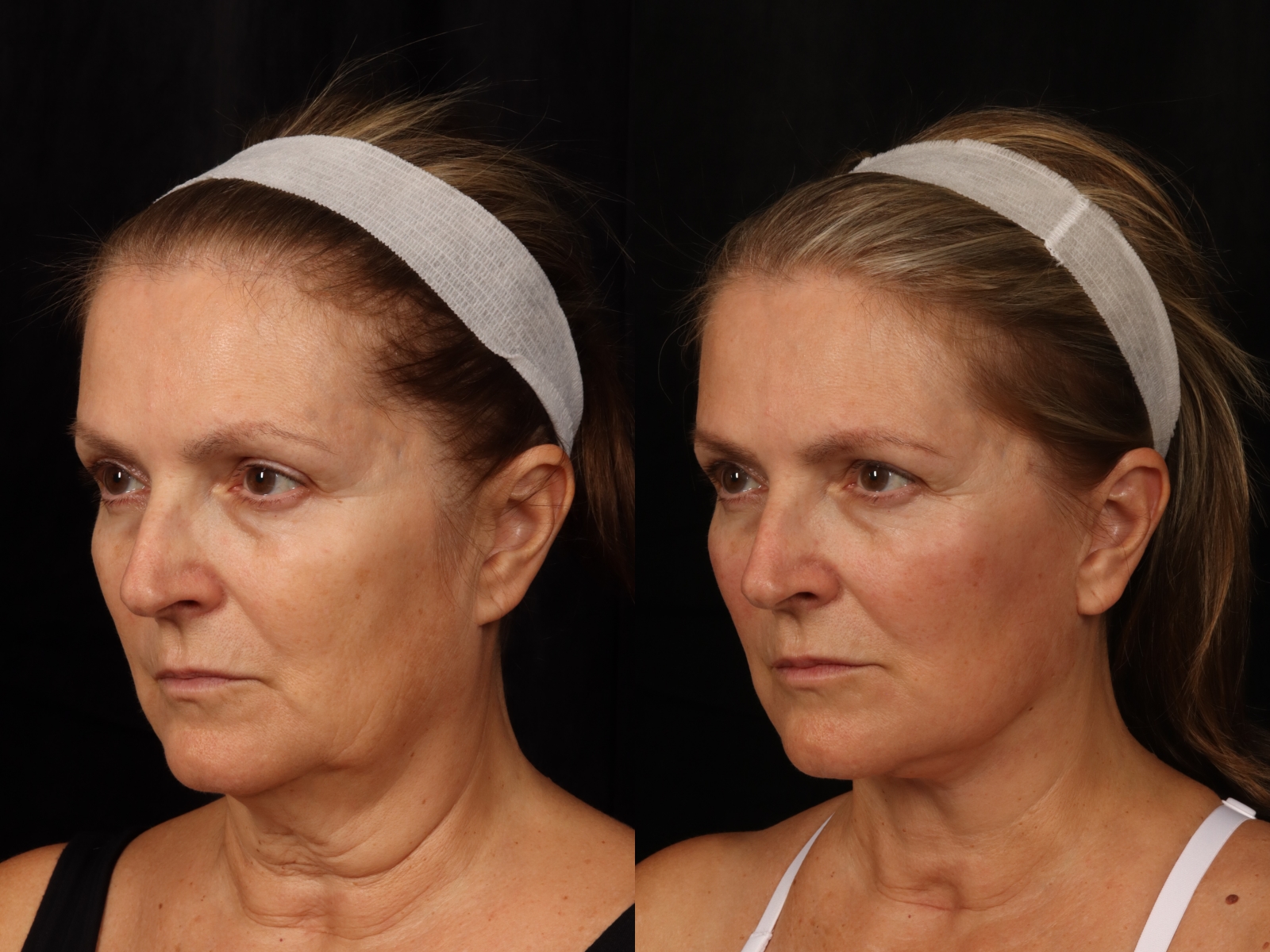 Facelift Before & After Photos | W Cosmetic Surgery