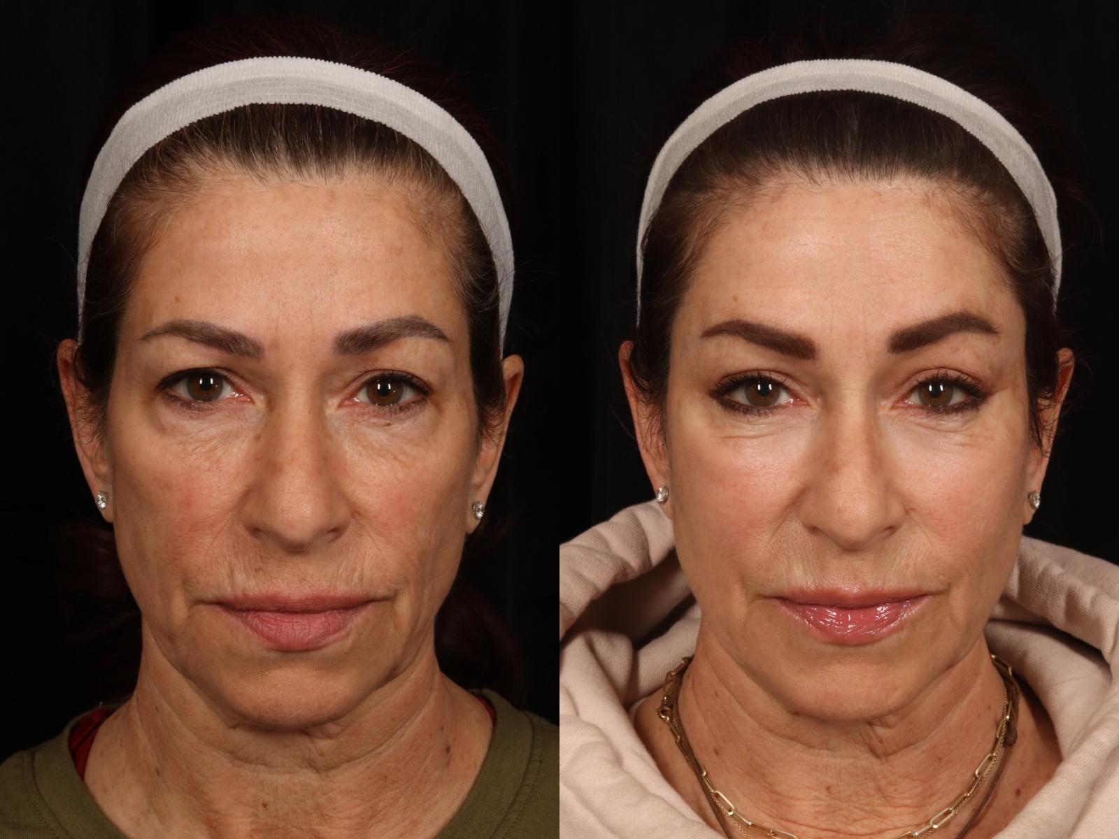 Mid Facelift Before & After Photos | W Cosmetic Surgery