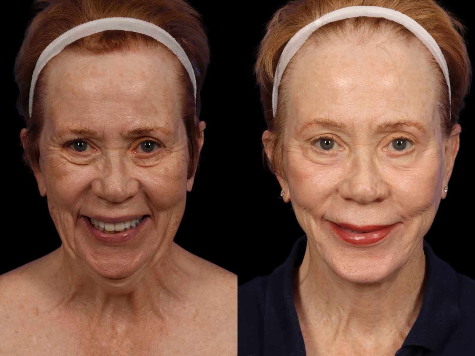 Chin Implant Before & After Photos | W Cosmetic Surgery