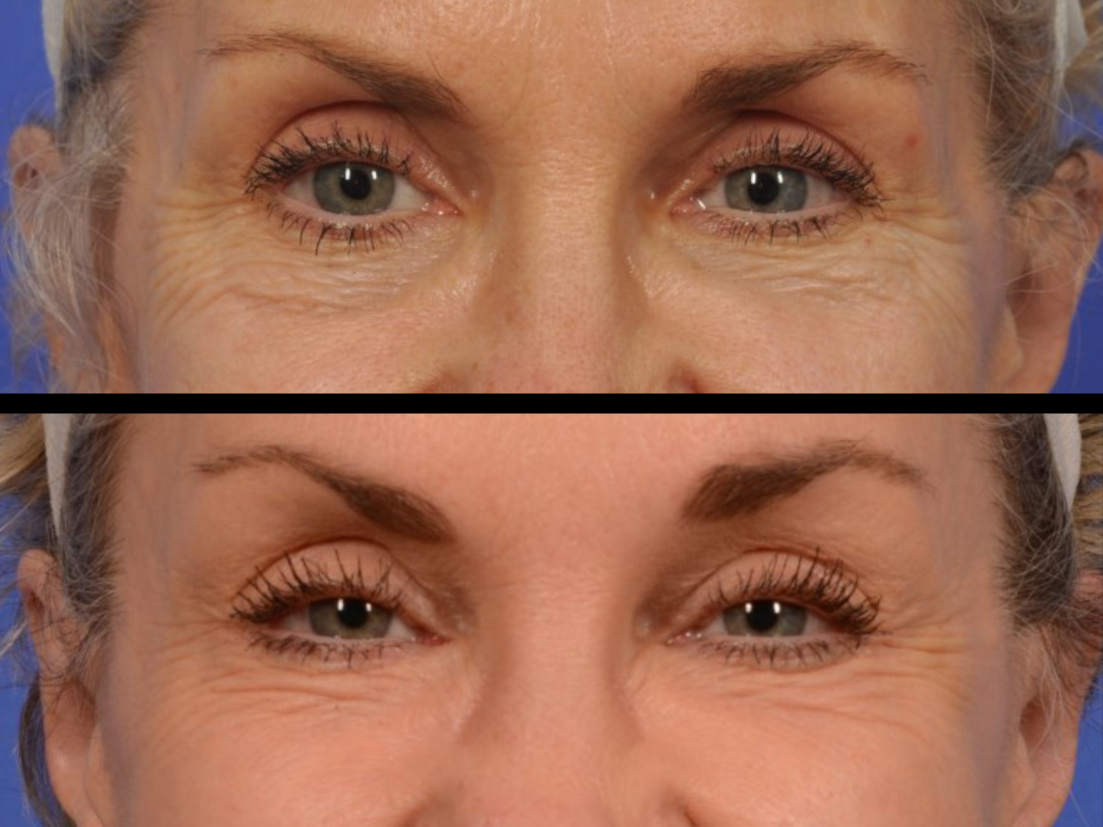 Laser Skin Resurfacing Before & After Photos | W Cosmetic Surgery