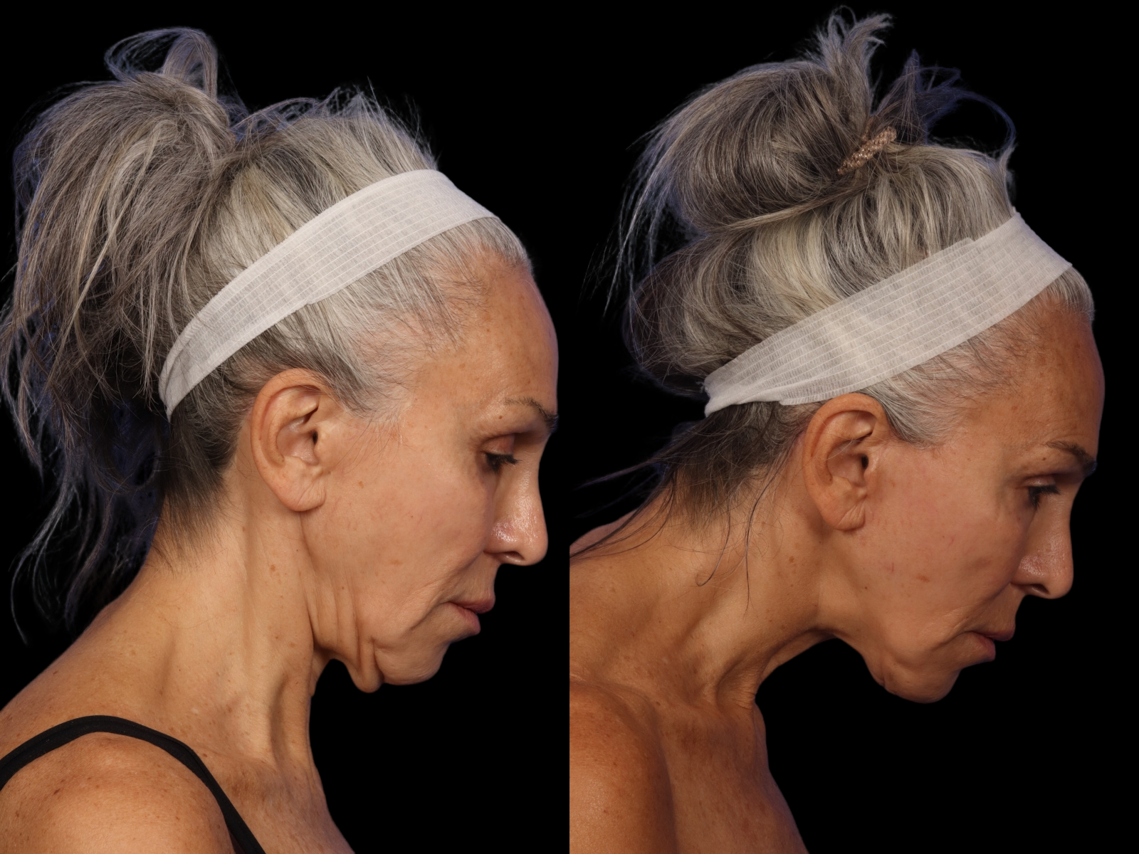 Chin Implant Before & After Photos | W Cosmetic Surgery