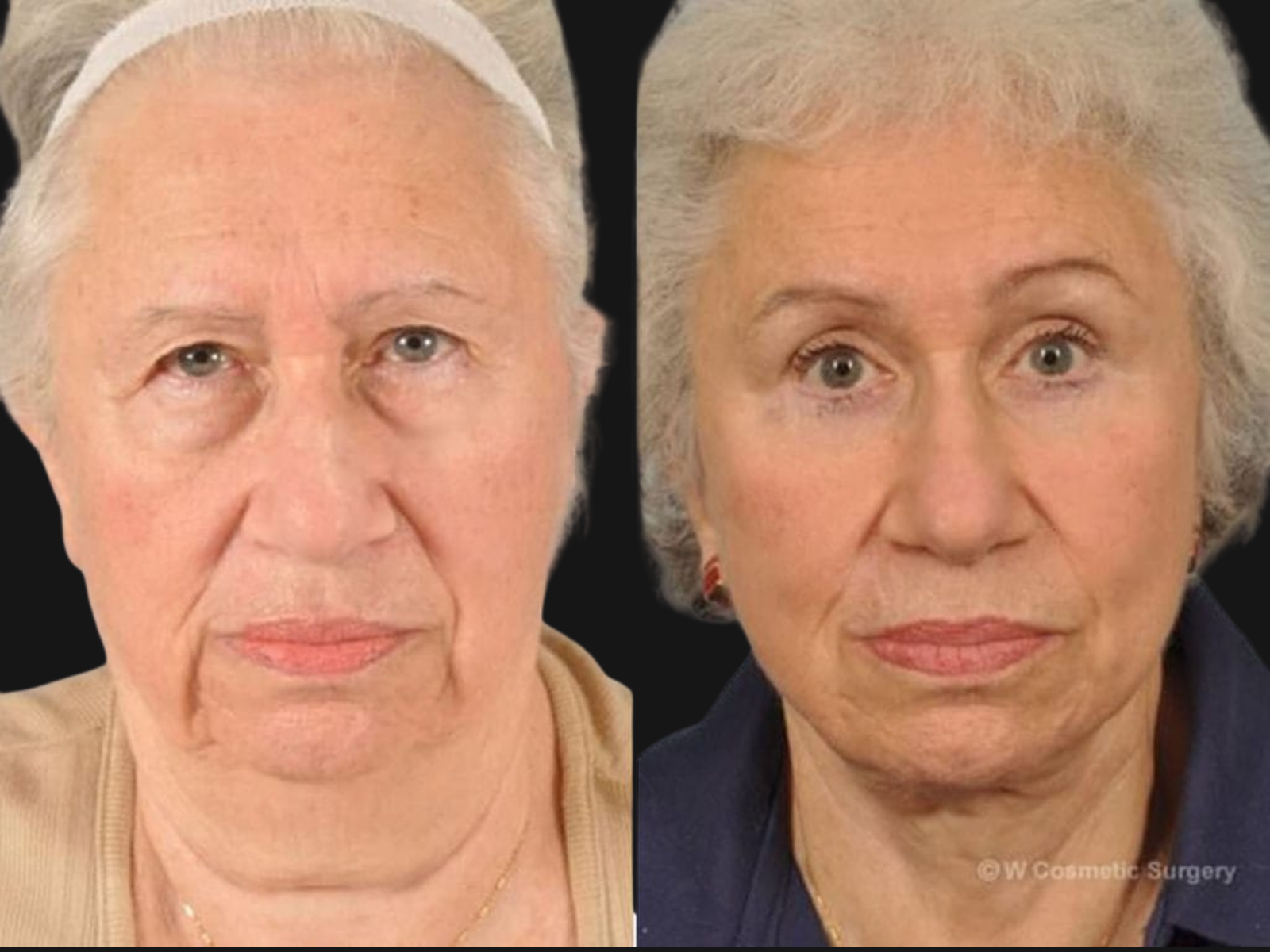 Droopy Eyelids – Ptosis Before & After Photos | W Cosmetic Surgery