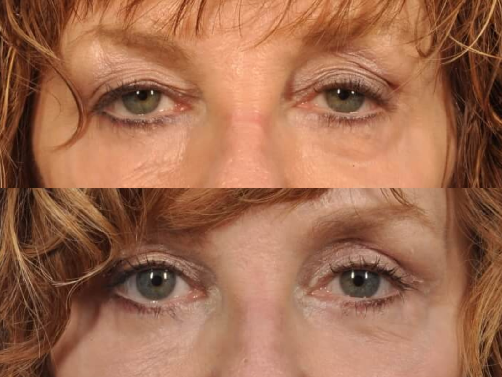 Festoon Surgery Before & After Photos | W Cosmetic Surgery