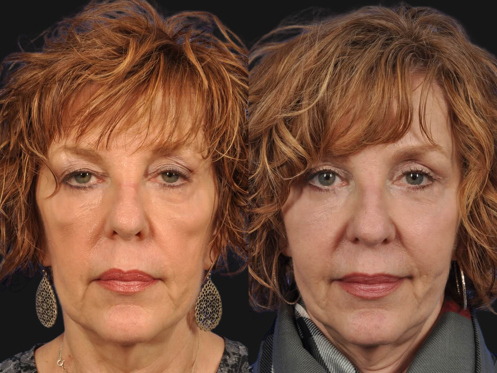 Festoon Surgery Before & After Photos | W Cosmetic Surgery