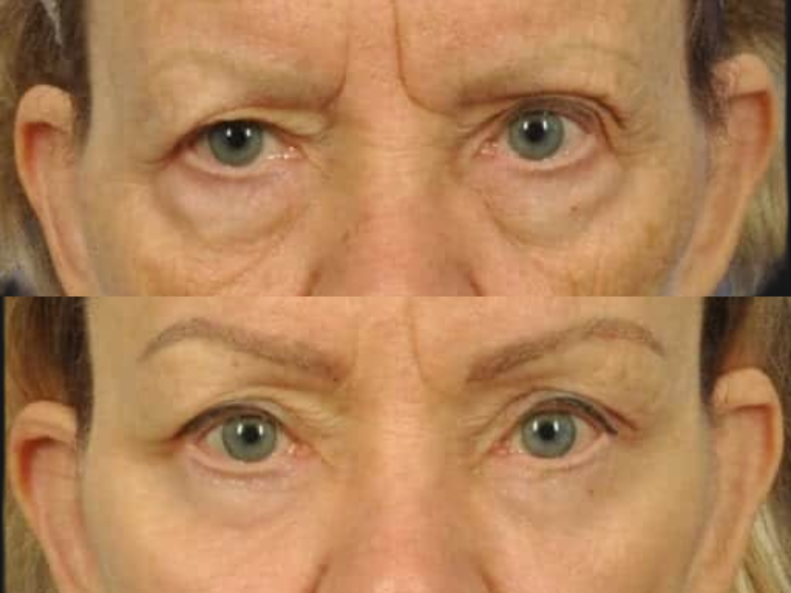 Festoon Surgery Before & After Photos | W Cosmetic Surgery