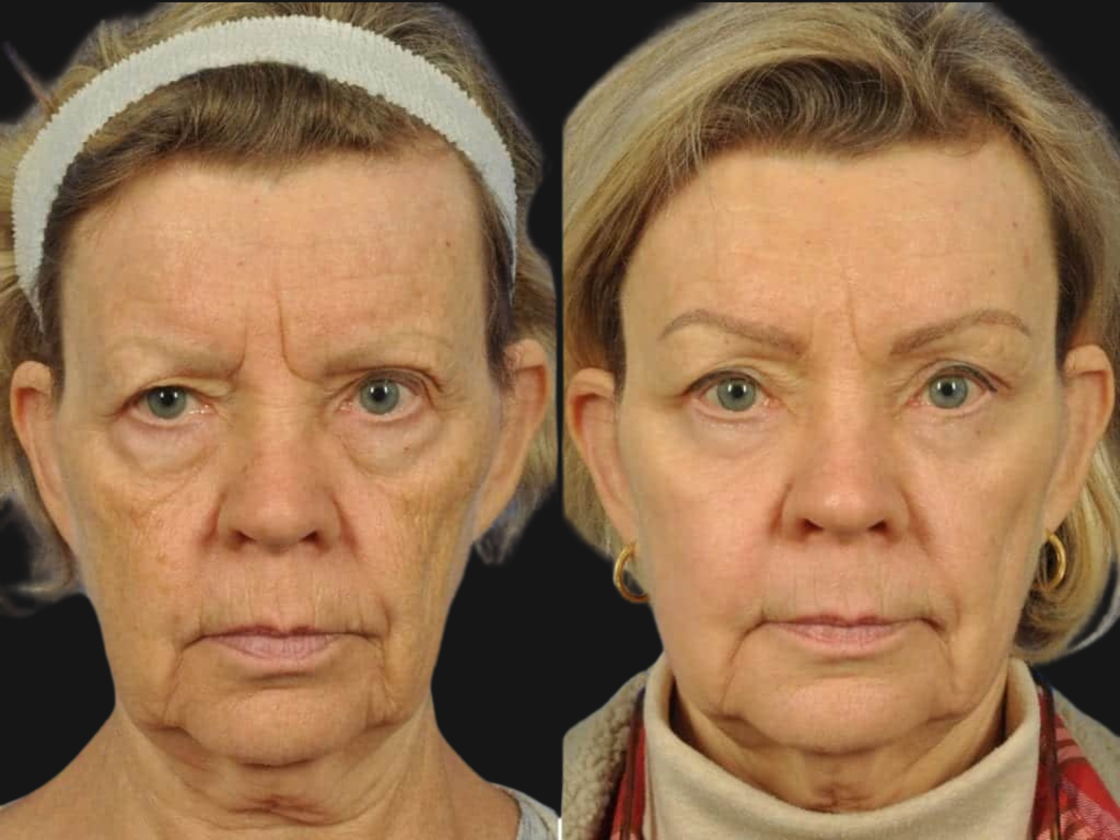 Festoon Surgery Before & After Photos | W Cosmetic Surgery