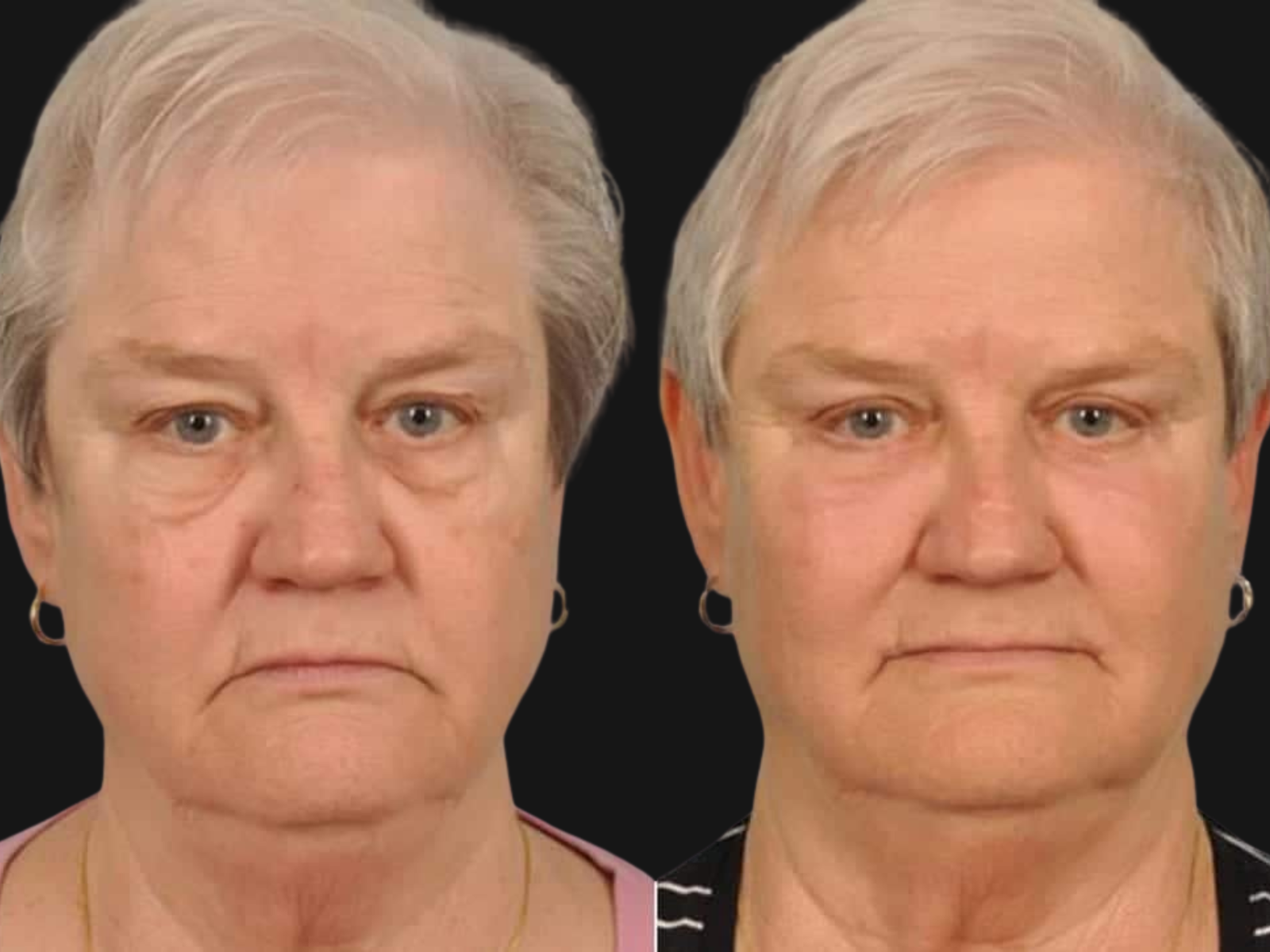 Festoon Surgery Before & After Photos | W Cosmetic Surgery