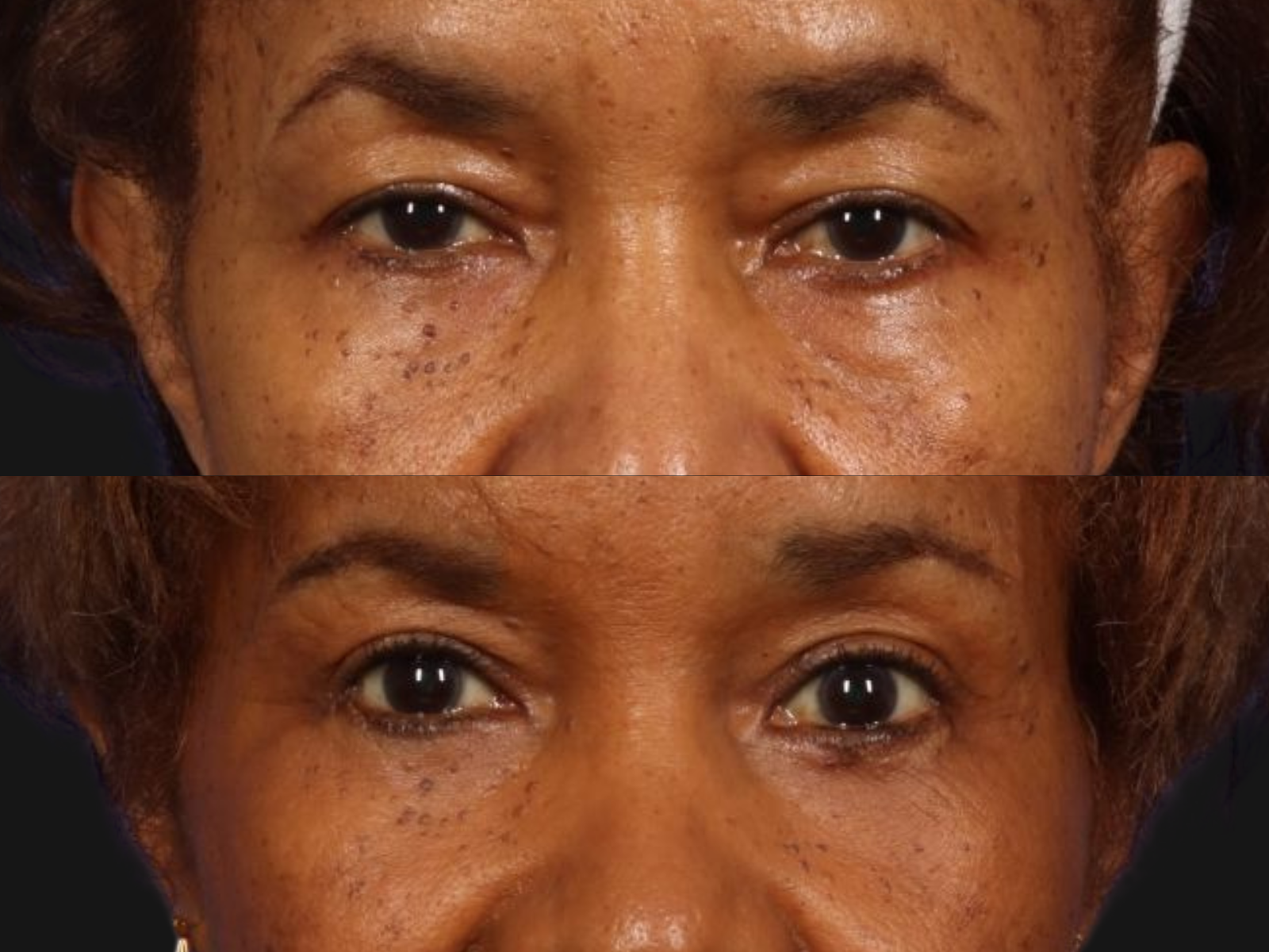 Festoon Surgery Before & After Photos | W Cosmetic Surgery