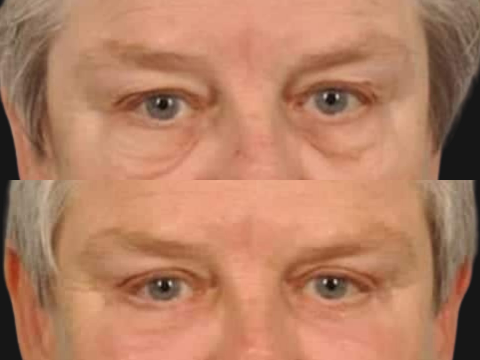 Blepharoplasty Before & After Photos | Page 5 | W Cosmetic Surgery