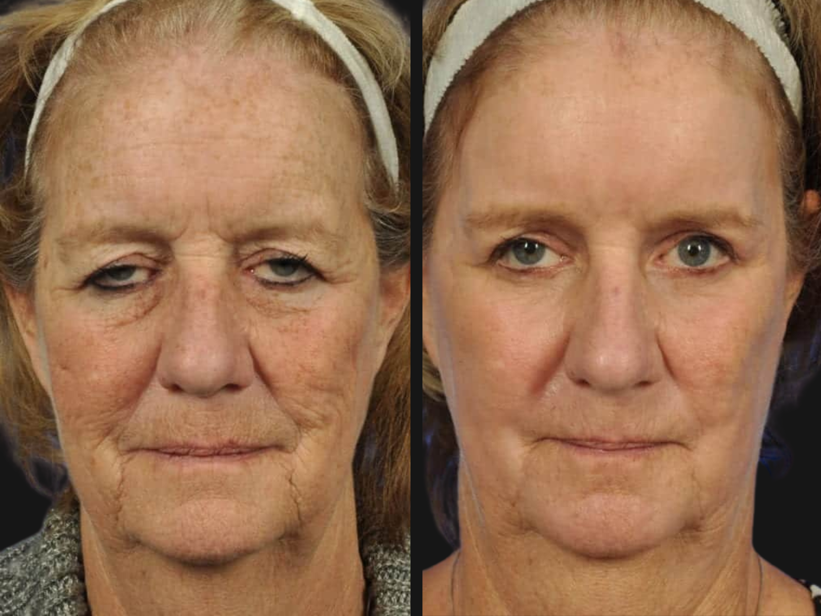 Brow Lift Before & After Photos | W Cosmetic Surgery