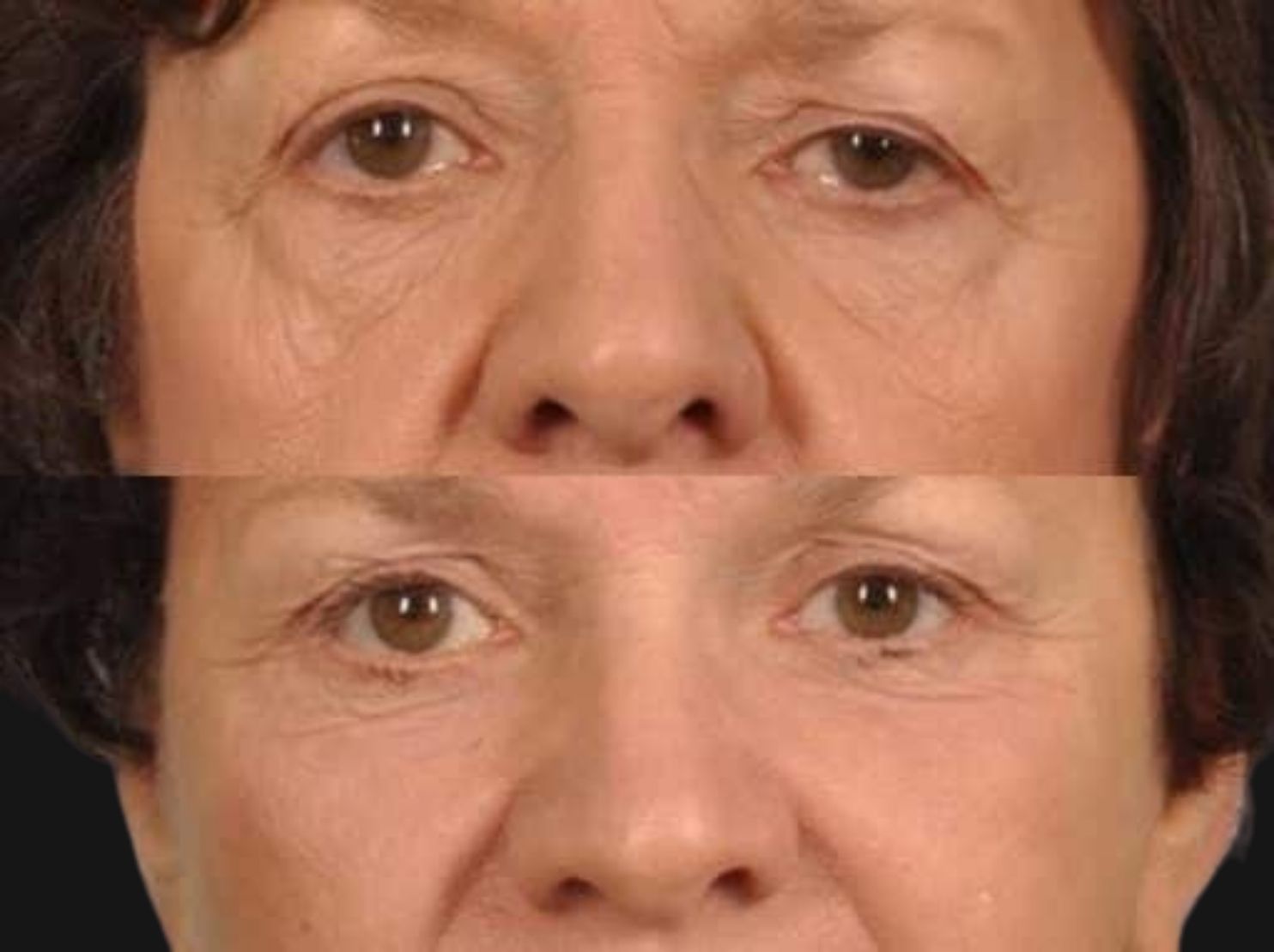 Festoon Surgery Before & After Photos | W Cosmetic Surgery