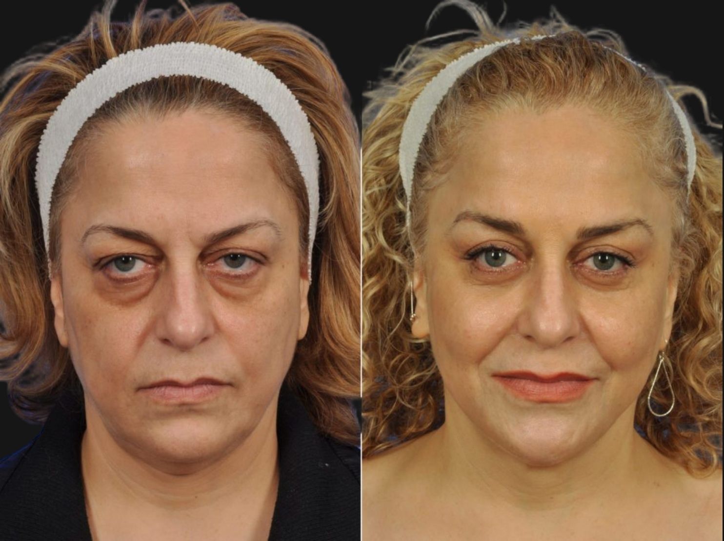 Festoon Surgery Before & After Photos | W Cosmetic Surgery