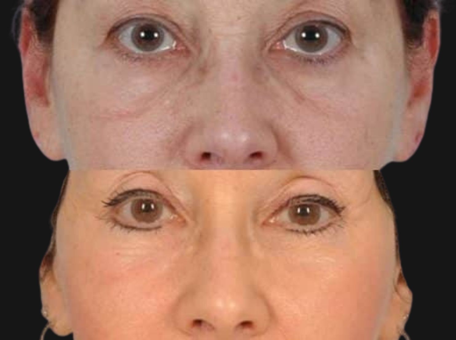 Festoon Surgery Before & After Photos | W Cosmetic Surgery