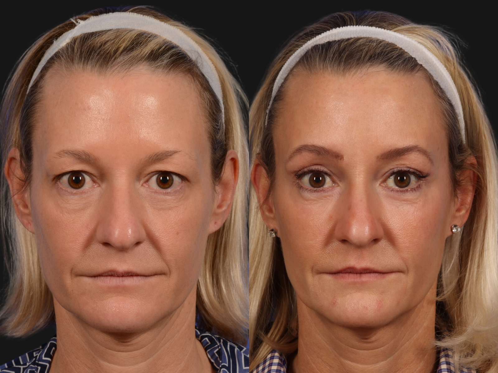 Blepharoplasty Before & After Photos | W Cosmetic Surgery