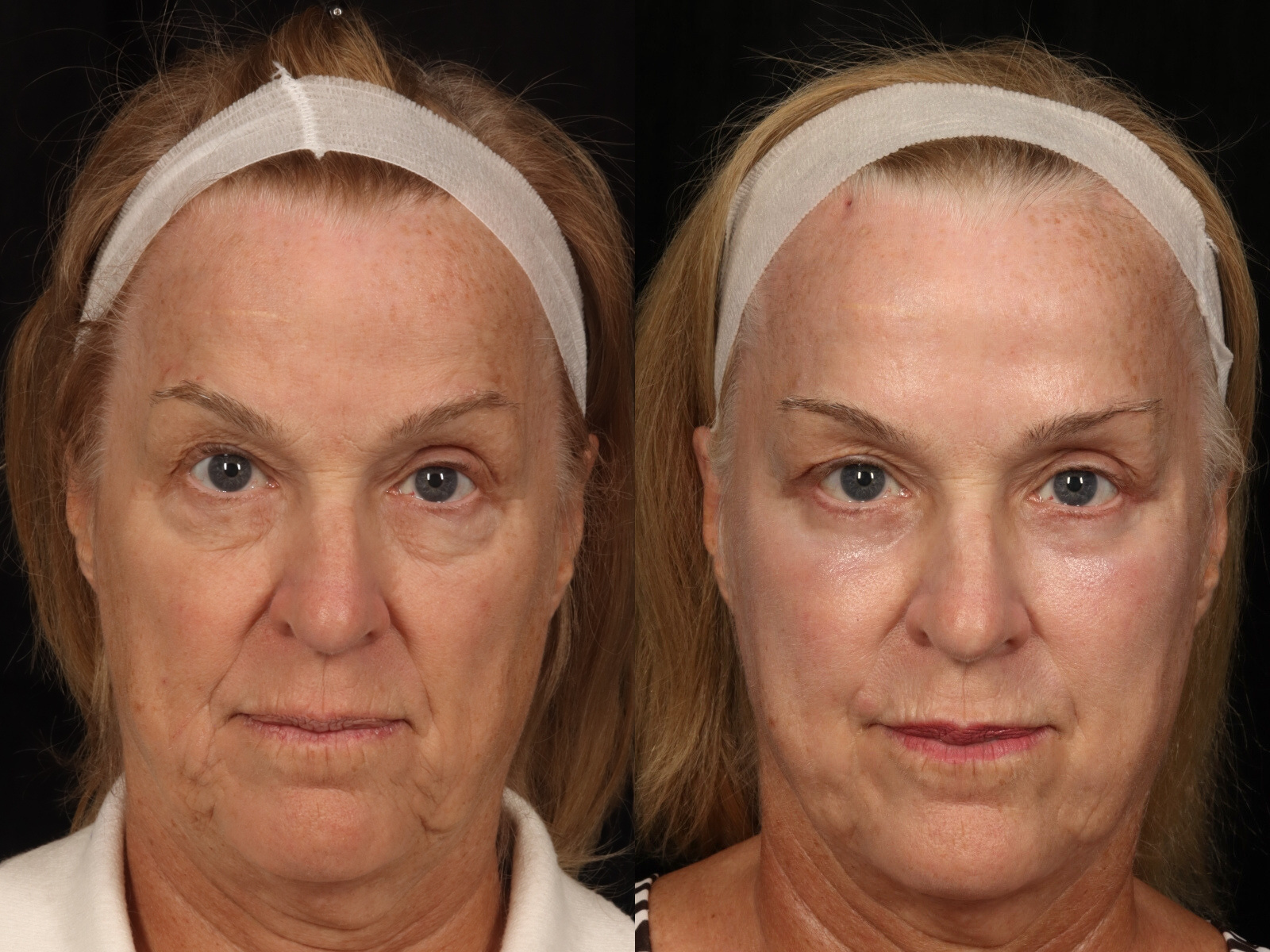 Mid Facelift Before & After Photos | W Cosmetic Surgery
