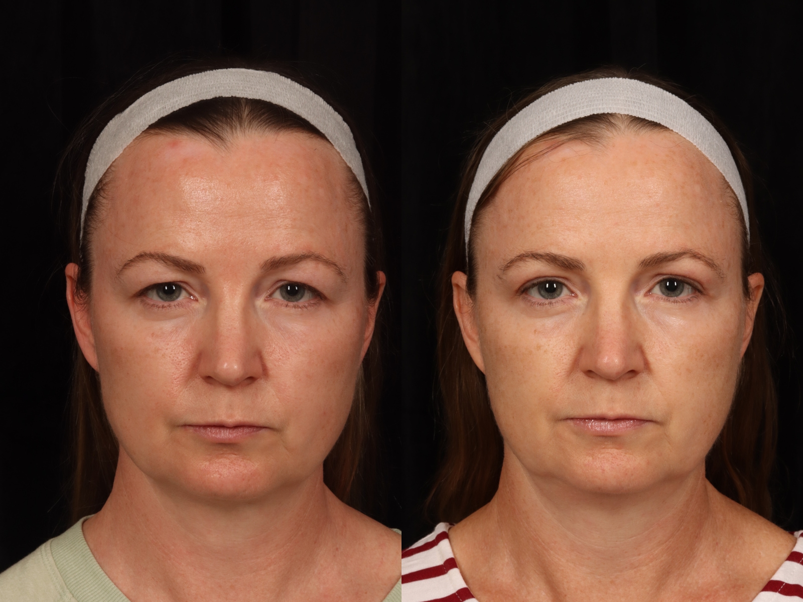 Blepharoplasty Before & After Photos | W Cosmetic Surgery
