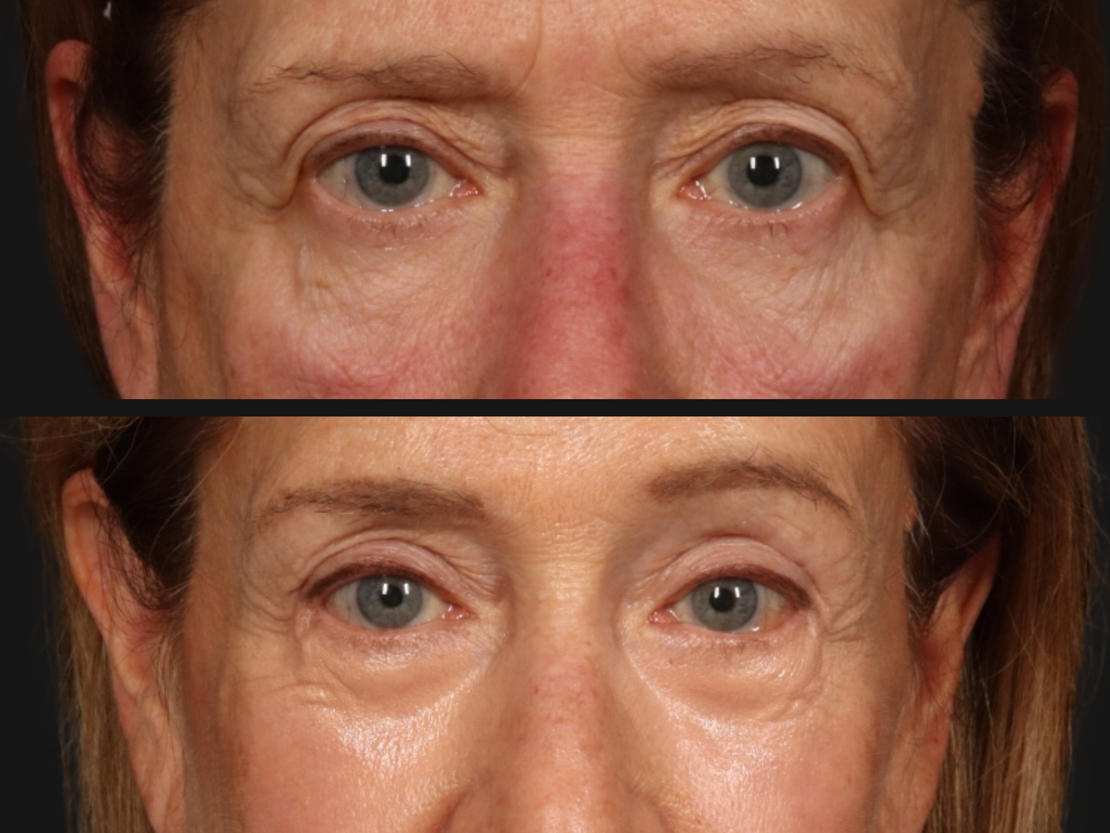 Festoon Surgery Before & After Photos | W Cosmetic Surgery