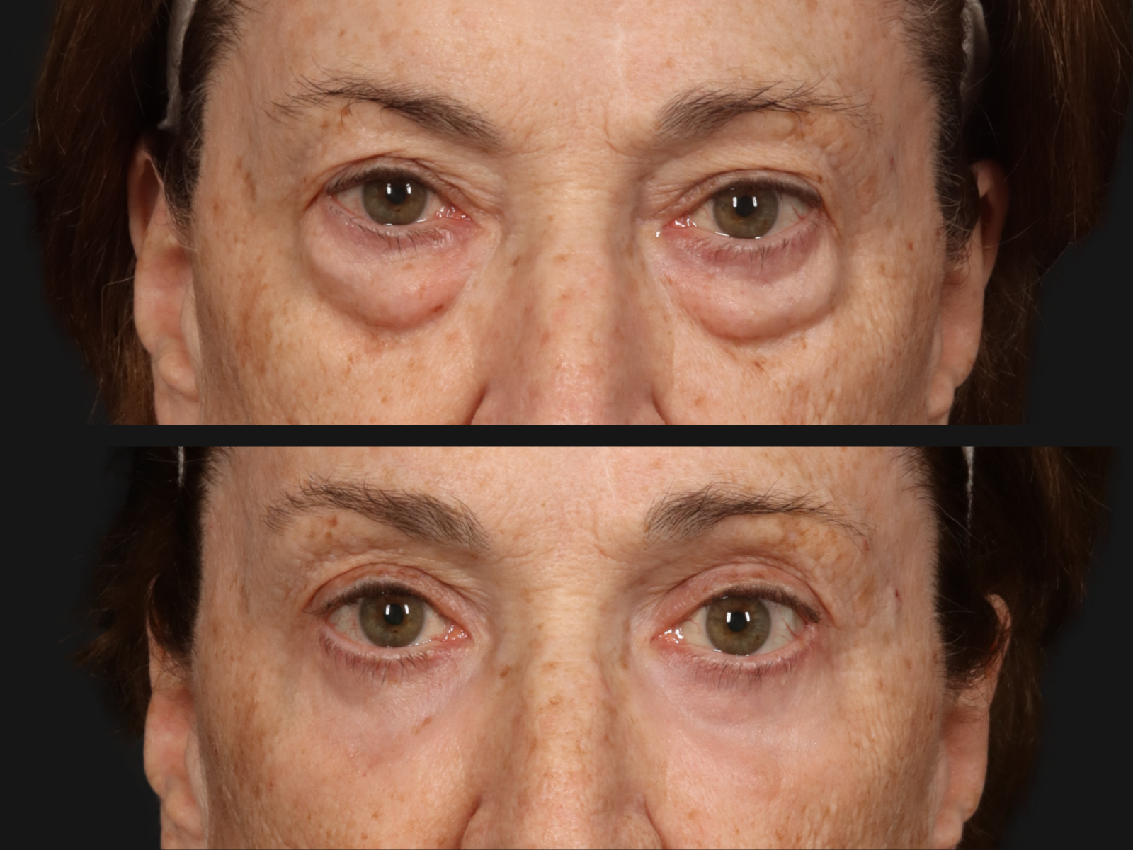 Blepharoplasty Before & After Photos | W Cosmetic Surgery