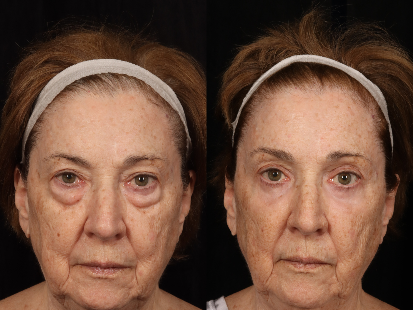 Blepharoplasty Before & After Photos | W Cosmetic Surgery