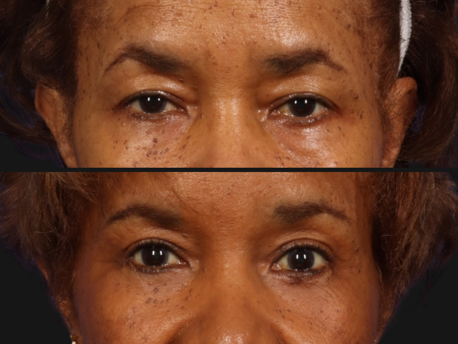 Festoon Surgery Before & After Photos | W Cosmetic Surgery