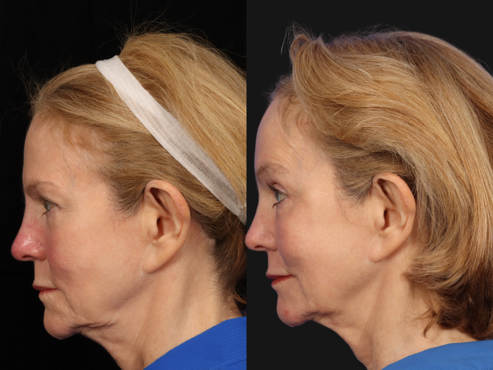 Mid Facelift Before & After Photos | W Cosmetic Surgery