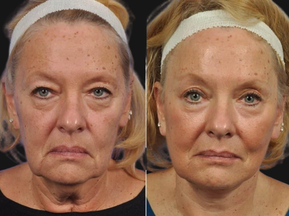 Mid Facelift Before & After Photos | W Cosmetic Surgery