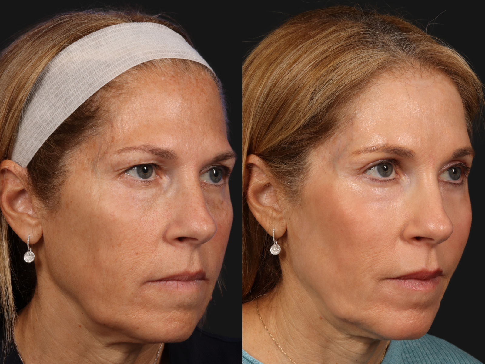 Mid Facelift Before & After Photos | W Cosmetic Surgery