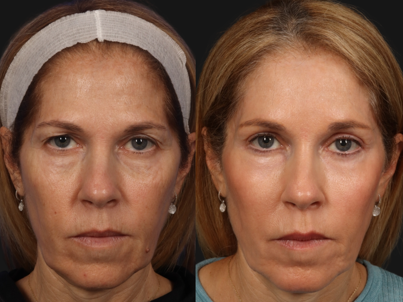 Mid Facelift Before & After Photos | W Cosmetic Surgery